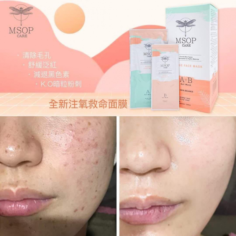 MSOP 救命面膜注氧CO2面膜 特強注氧面膜升級版 | 即時祛粉刺祛痘，深層修復爛面，敷完即時BB肌 | (每盒6次用) A+B溝黎用 *送 ...