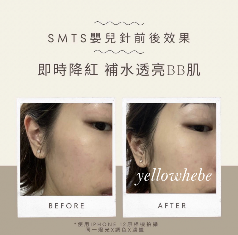 [授權代理正貨] (美容院專用) 韓國sMTS幹細胞嬰兒肌療程💦 無痛無創植入深層 打造自然水光肌 ( 一套可以用十次) - YELLOWHEBE SHOP