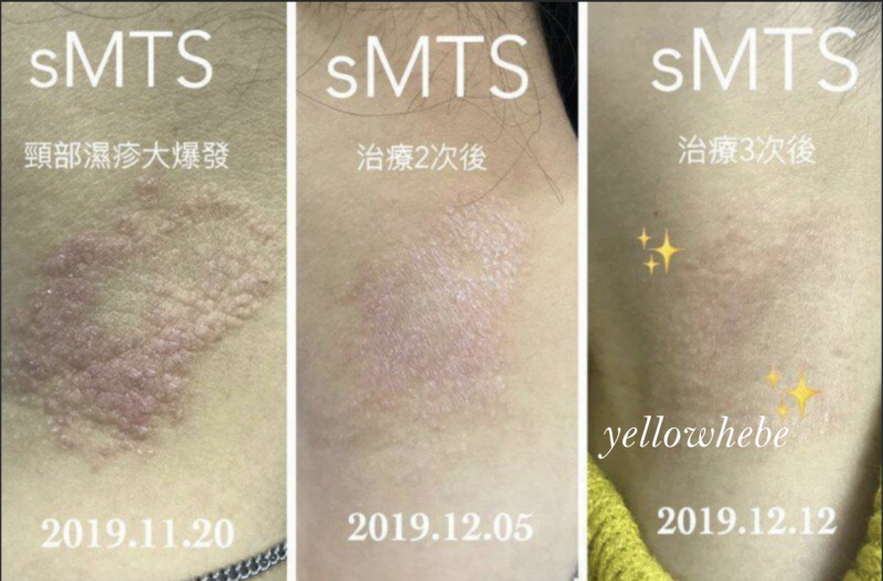 [授權代理正貨] (美容院專用) 韓國sMTS幹細胞嬰兒肌療程💦 無痛無創植入深層 打造自然水光肌 ( 一套可以用十次) - YELLOWHEBE SHOP
