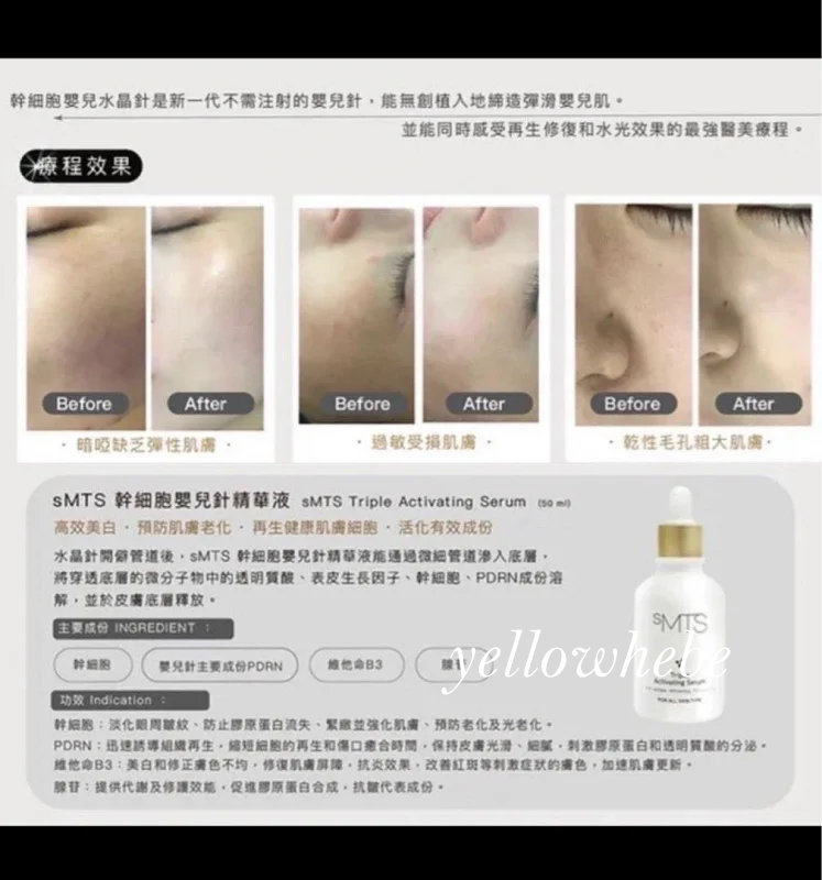 [授權代理正貨] (美容院專用) 韓國sMTS幹細胞嬰兒肌療程💦 無痛無創植入深層 打造自然水光肌 ( 一套可以用十次) - YELLOWHEBE SHOP