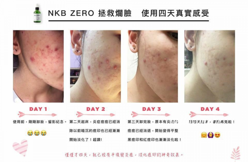 日本HERY NKB Zero 淡印抗敏抗痘修護美容精華 29ml - YELLOWHEBE SHOP
